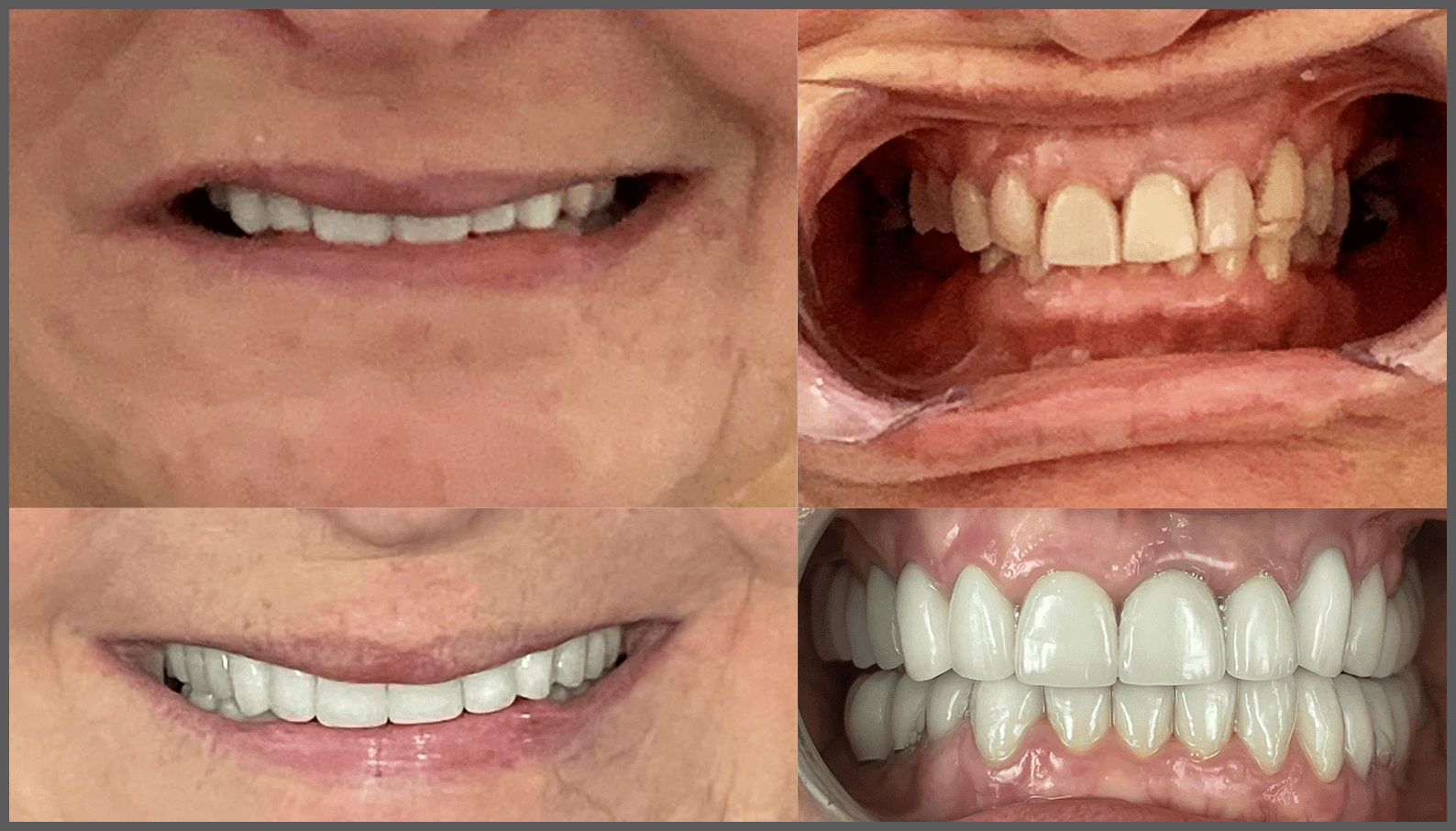 Full Mouth Rehabilitation - Aspire Dental