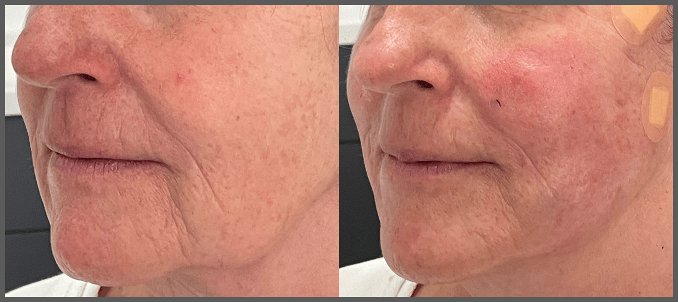 Threadlifting - Aspire Dental